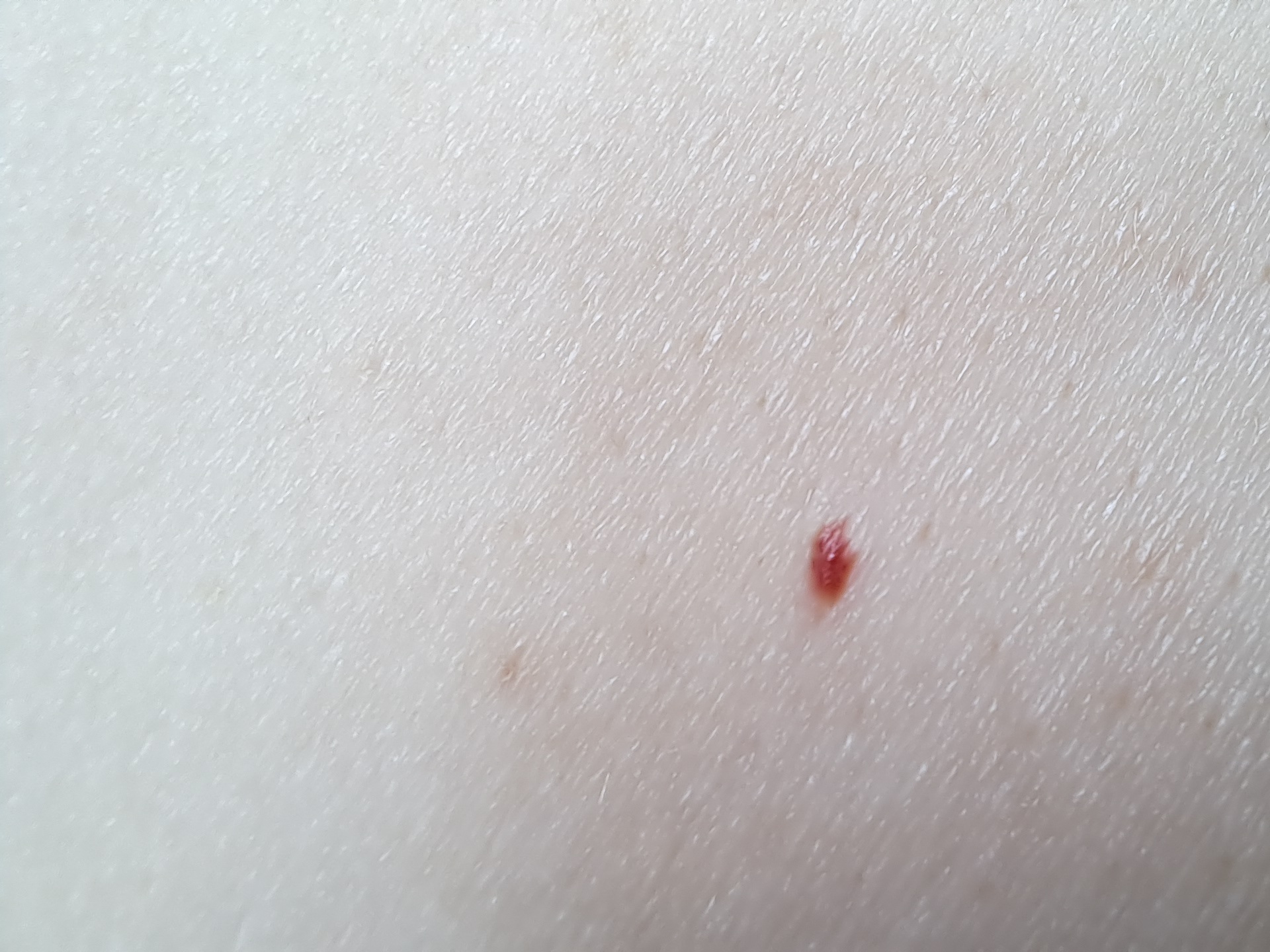 Rubinki na skórze - czym są i jak je usunąć?